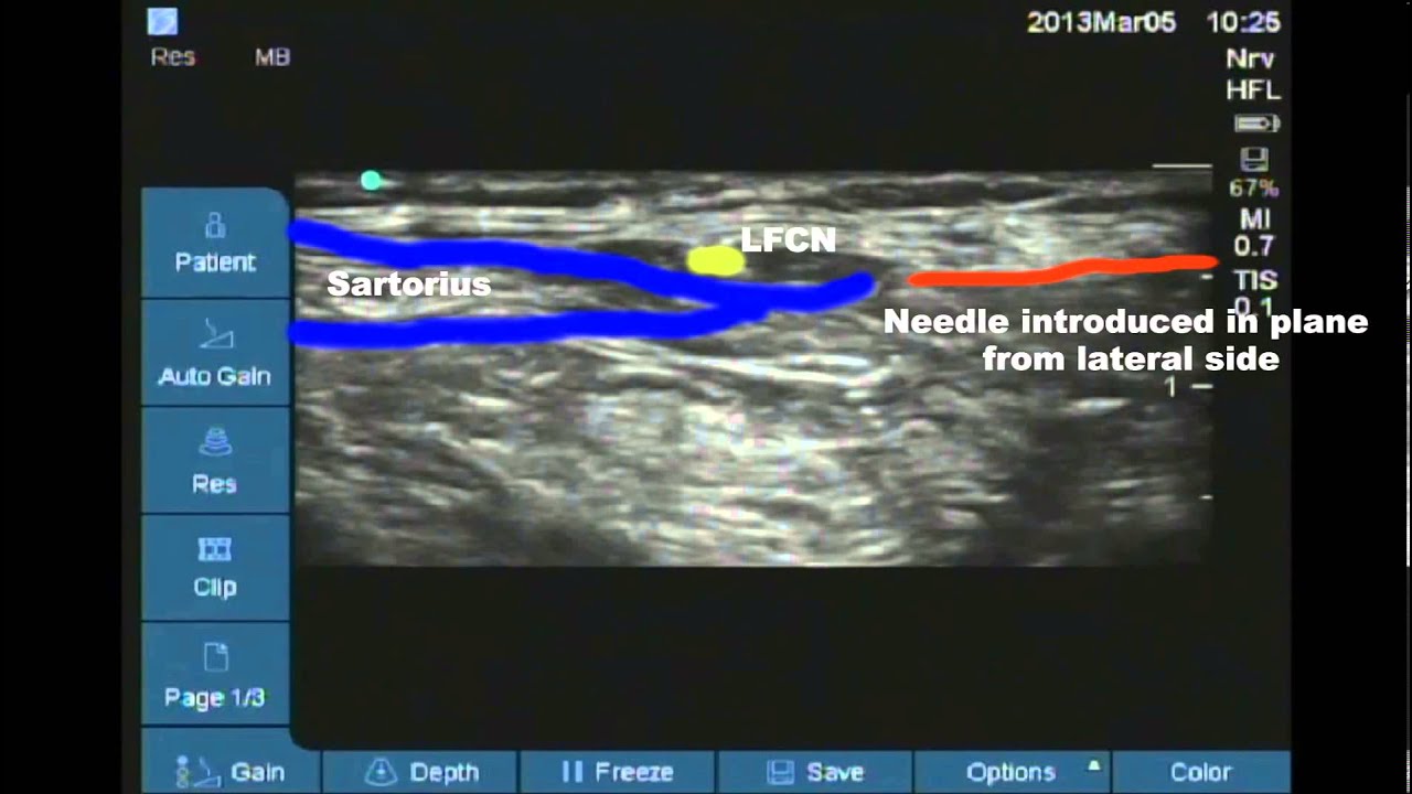 Ultrasound guided lateral femoral cutaneous nerve of thigh block - YouTube