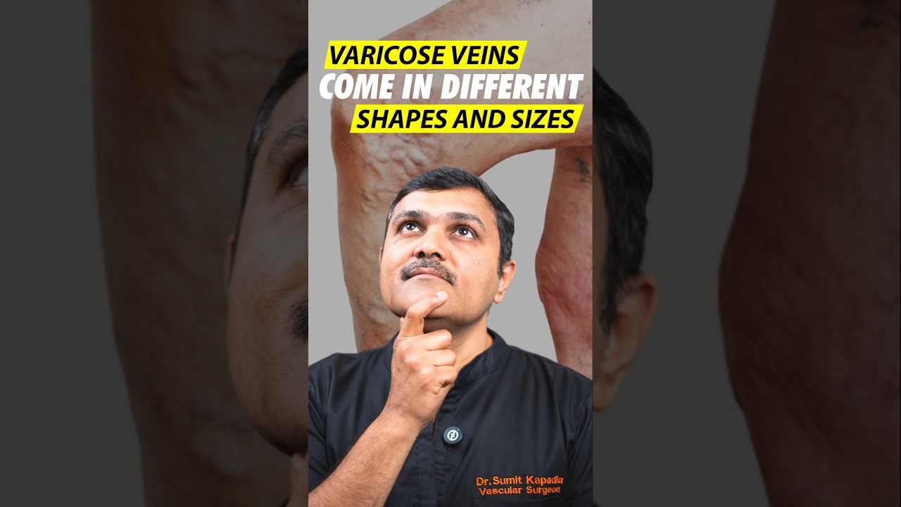 Deep Vein Thrombosis vs. Varicose Veins: A Complete Guide
