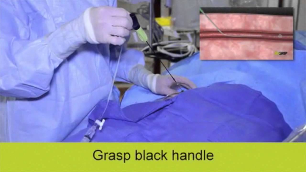 MynxGrip Vascular Closure Device Live Case - YouTube