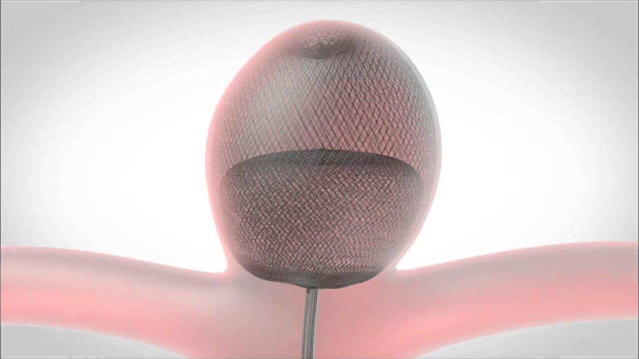 WEB : Woven Endobridge Device - YouTube