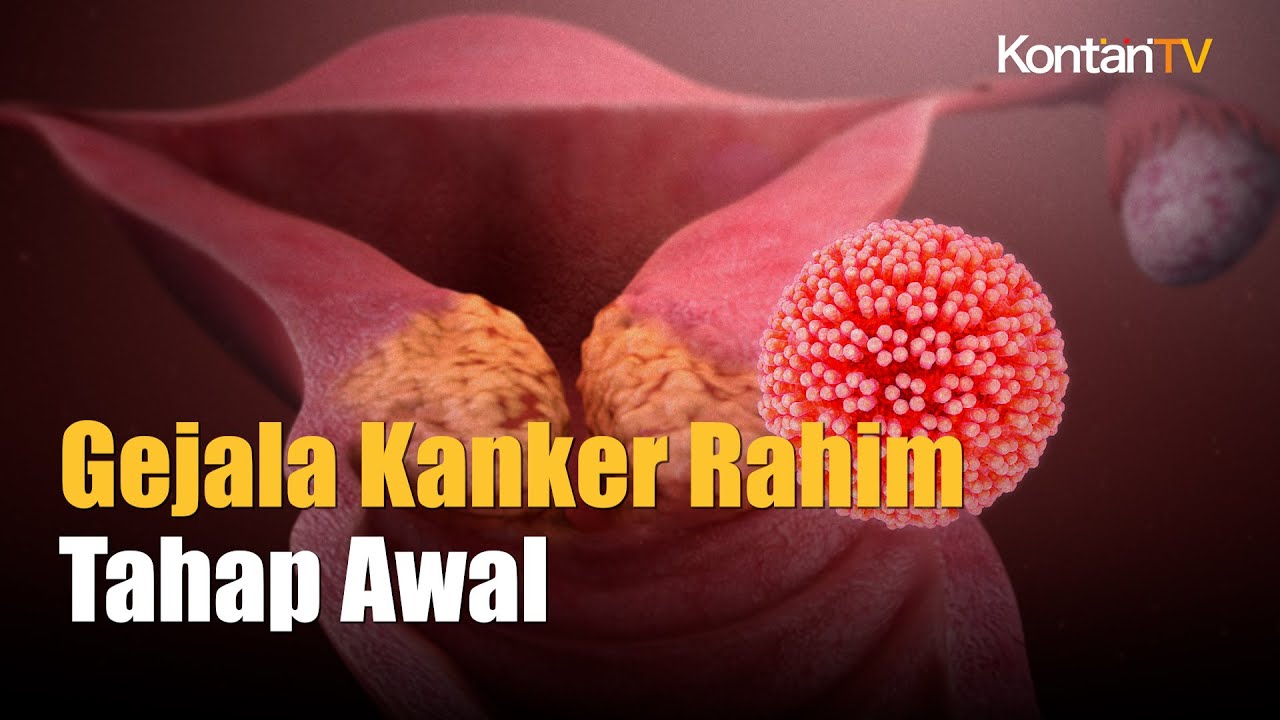 Perempuan Harus Tahu, Gejala Kanker Rahim Tahap Awal